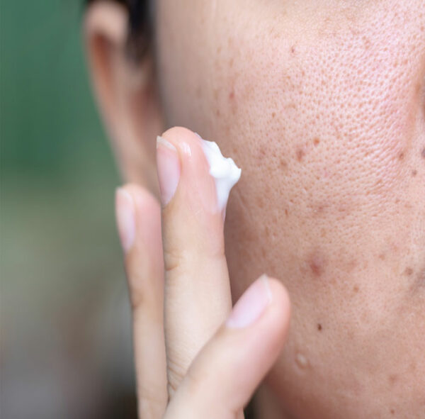 Scar Camouflage Perth - Dark Scar Treatment