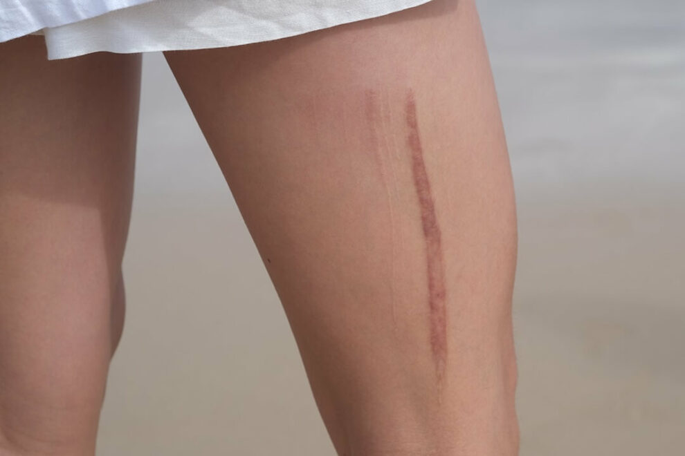 Skin Treatment Clinic Perth - Refined Skin & Scar Treatments